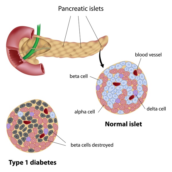Type 1 Diabetes Symptoms, Causes, Preventions And Cure Type 1 Diabetes Symptoms, Causes, Preventions And Cure