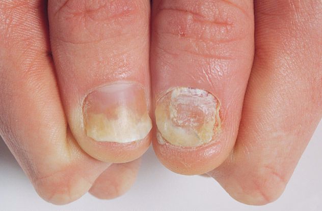 Psoriatic Arthritis Types, Causes, Symptoms, Diagnosis & Treatment