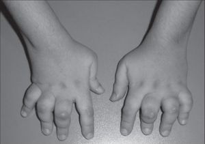 Juvenile Idiopathic Arthritis (JIA) Signs, Subtypes, Cause, Diagnosis ...