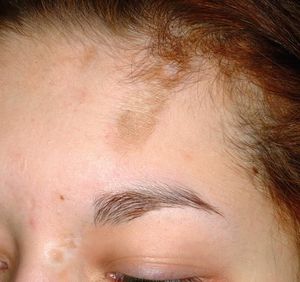 Juvenile Dermatomyositis (JDM) Symptoms, Causes, Diagnosis & Treatment